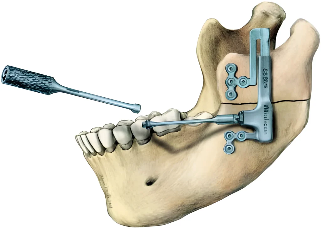Distraction Osteogenesis in Amarillo, TX